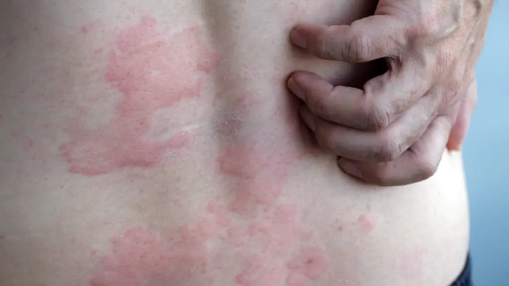 Global Study Reveals Effective Treatments for Chronic Hives ...